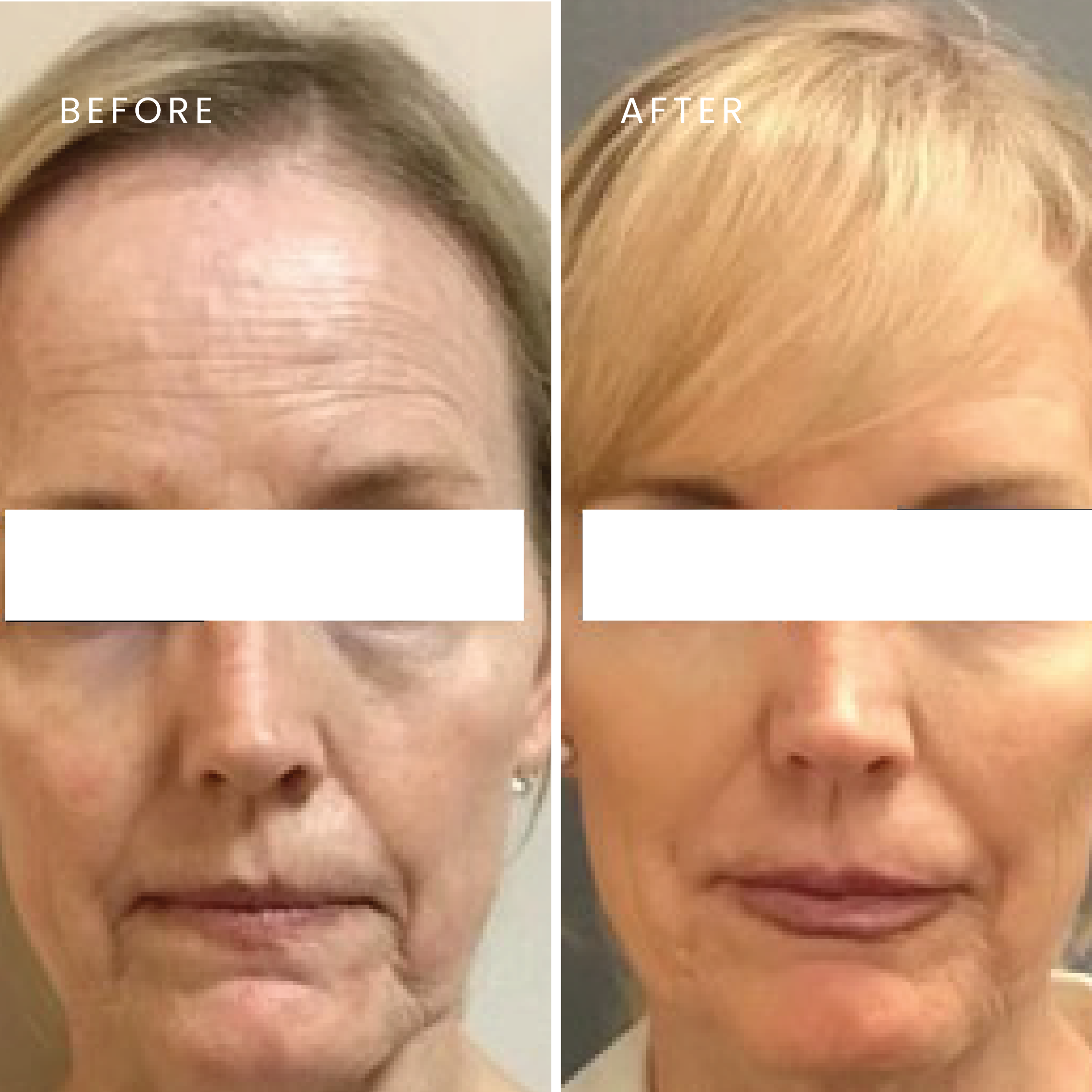 Dermal Fillers | Timeless Elements Med Spa & Laser Center | Forest Lake, MN